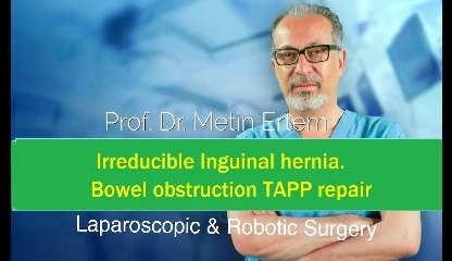 Irreducible Inguinal hernia & Bowel obstruction. TAPP - MT2Priv