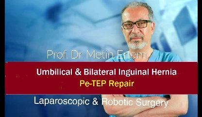 Laparoscopic Pe-TEP Repair. Umbilical & Bilateral ing - MT2Priv